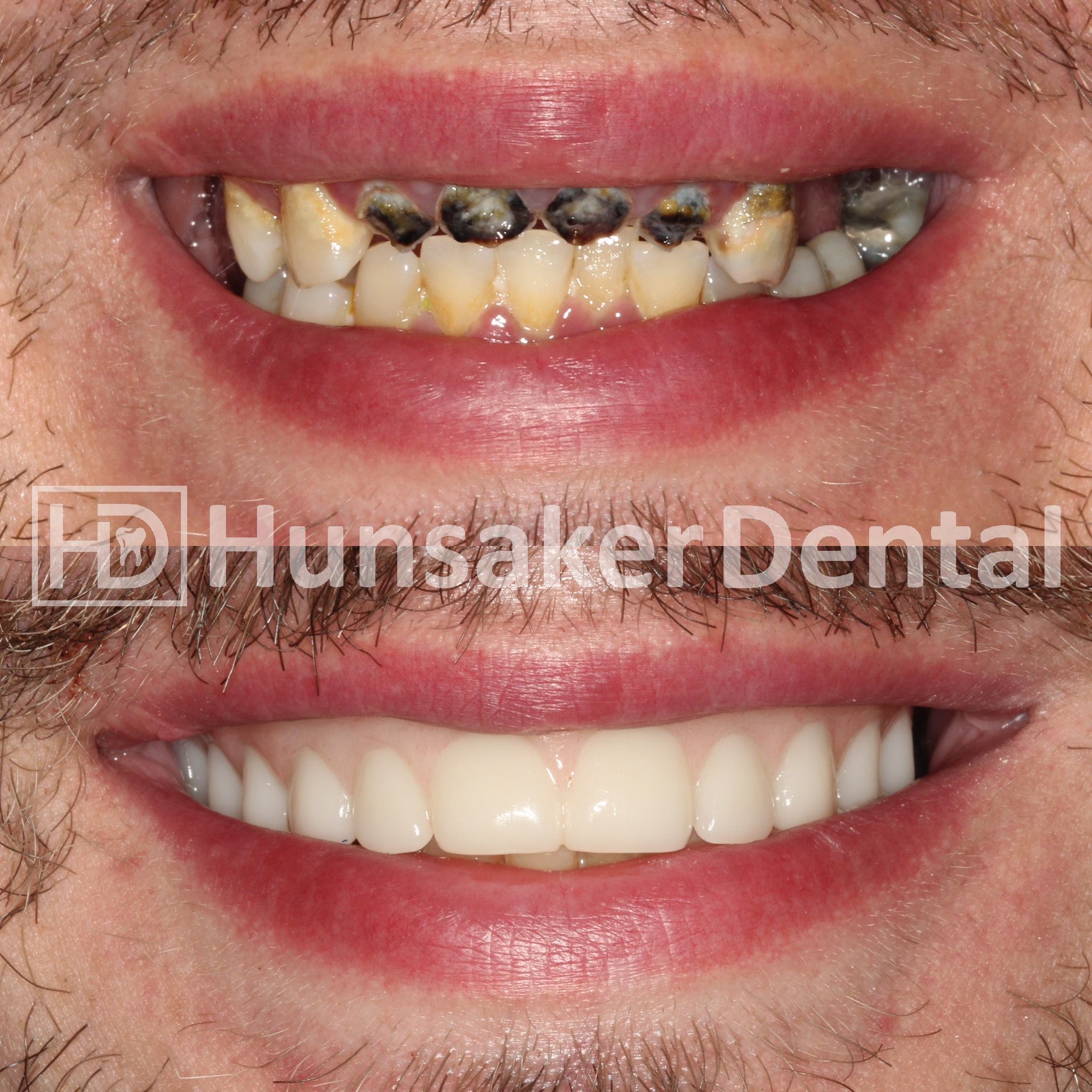 Full Mouth Dental Implants - Hunsaker Dental - Salem and Monmouth ...